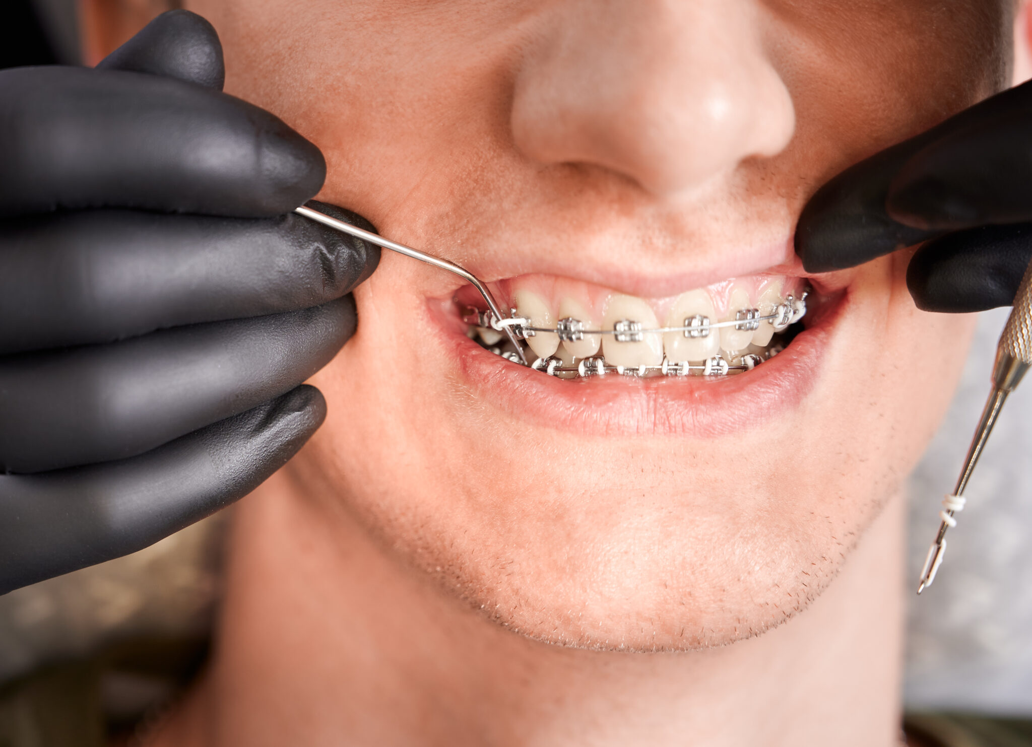 Traditional Braces
